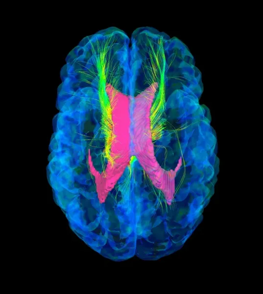 Brain fibres, DTI MRI scan C017 / 7037 Our beautiful Wall Art and Photo ...