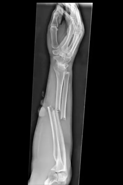 Broken Arm X Ray